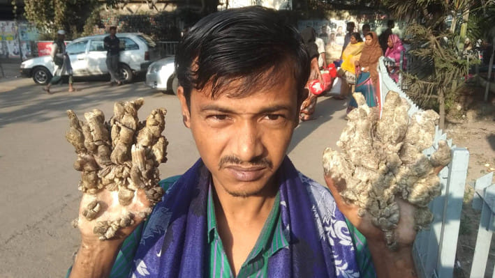 tree-man disease | The Daily Star