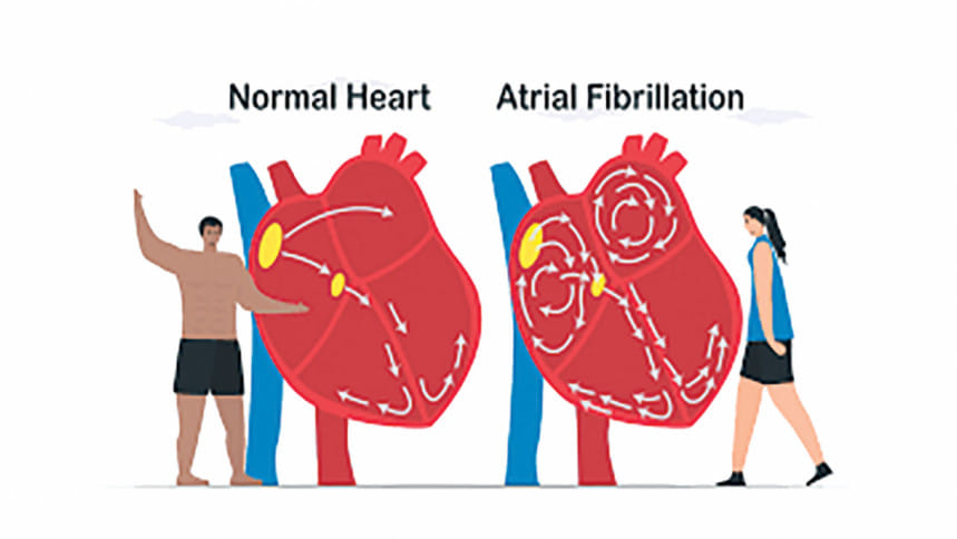 Warning signs of atrial fibrillation | The Daily Star