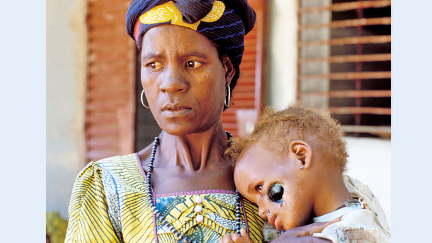 WHO officially recognises noma as a neglected tropical disease | The ...