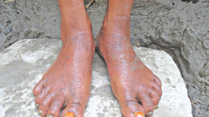 Bangladesh Flood: Diseases spread as floodwater starts receding