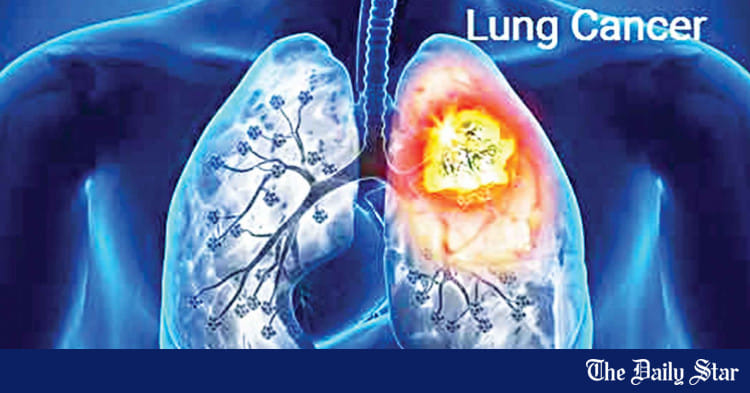 All you need to know about lung cancer | The Daily Star