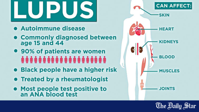 Life after lupus | The Daily Star