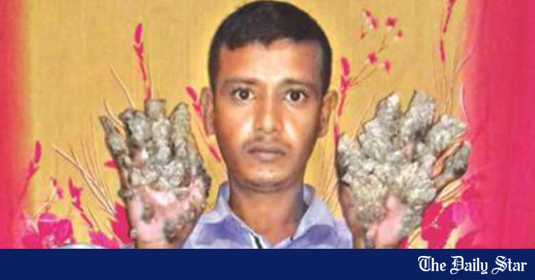 Bangladesh ‘Tree-man’ admitted to DMCH again for treatment