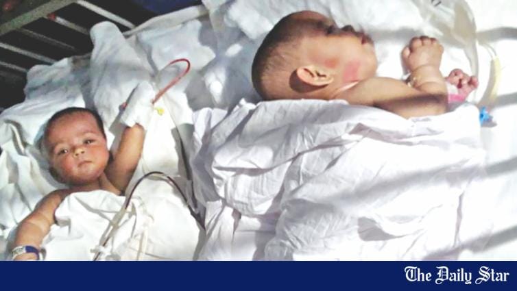 Doing ‘normal’, split twins to get released Sunday | The Daily Star