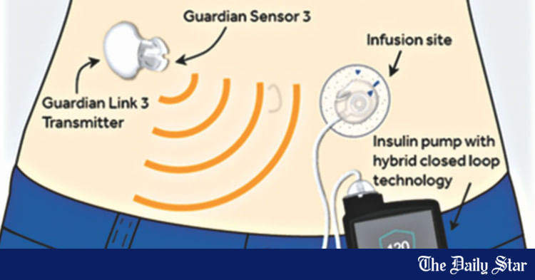 Artificial pancreas treatment improves glycaemic control in type 1 ...
