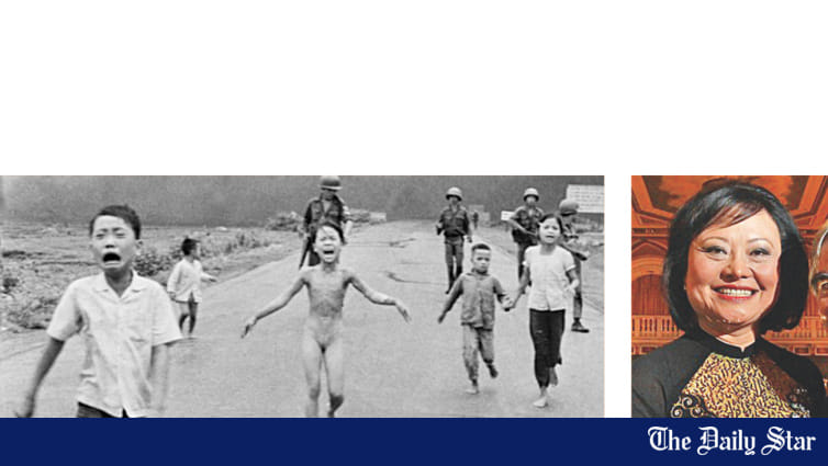 Vietnam 'napalm girl' starts free course of laser treatment | The Daily ...