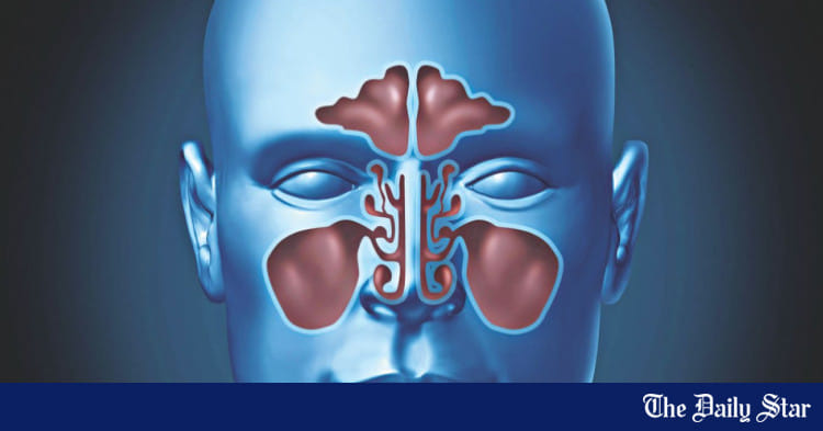 Common nasal disorders | The Daily Star