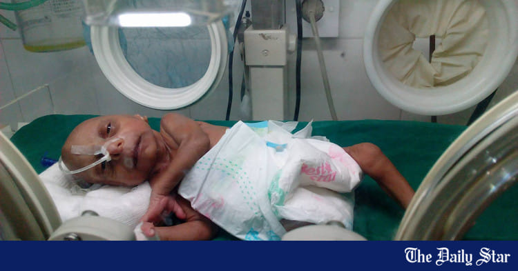 Baby with suspected Progeria born in Dhaka