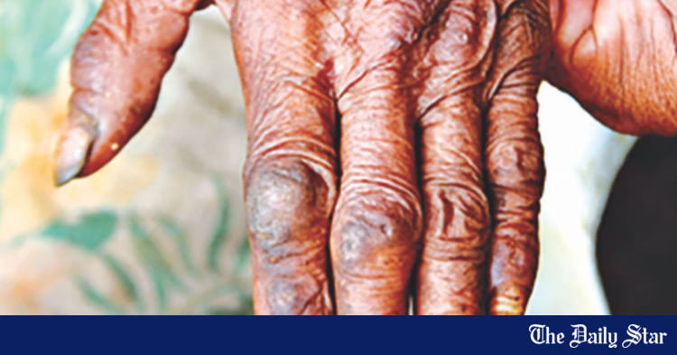 What happens when sand fleas burrow in your skin? | The Daily Star