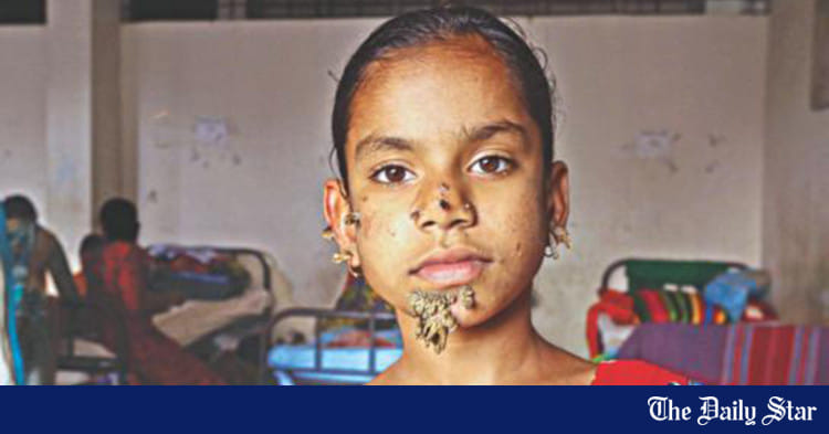 'Tree-Man Syndrome': Doctors hopeful after Shahana’s surgery