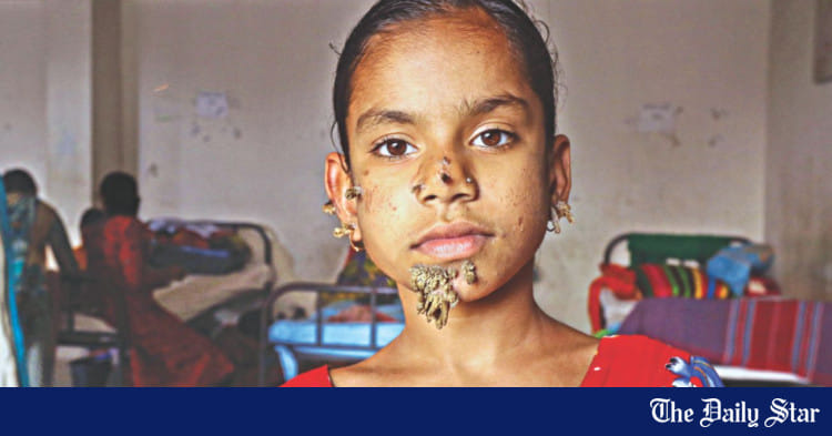 10-year-old girl feared to have 'tree man' disease | The Daily Star