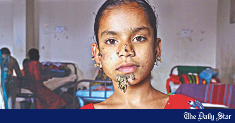 'Tree Man Syndrome': Shahana to go under the knife within a week | The ...
