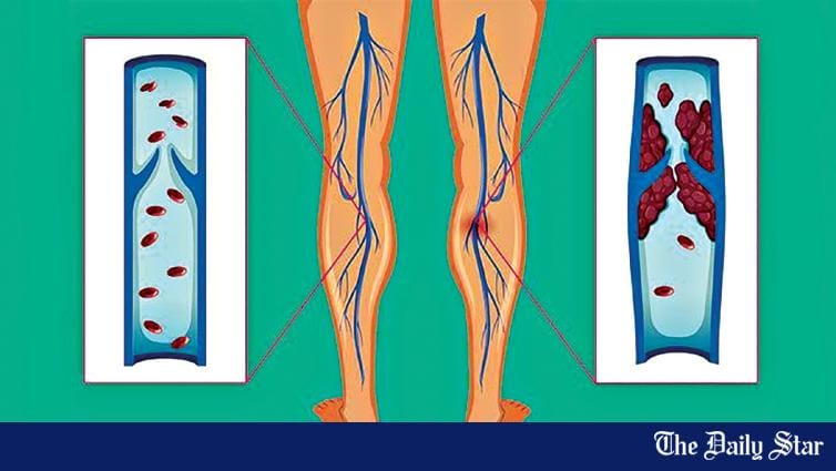 Understanding deep vein thrombosis | The Daily Star