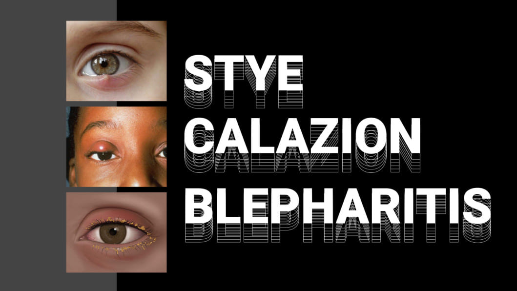 Hordeolum Vs Chalazion